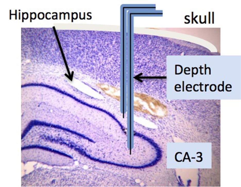 Cortical Sensory Evoked Potentials - Melior Discovery