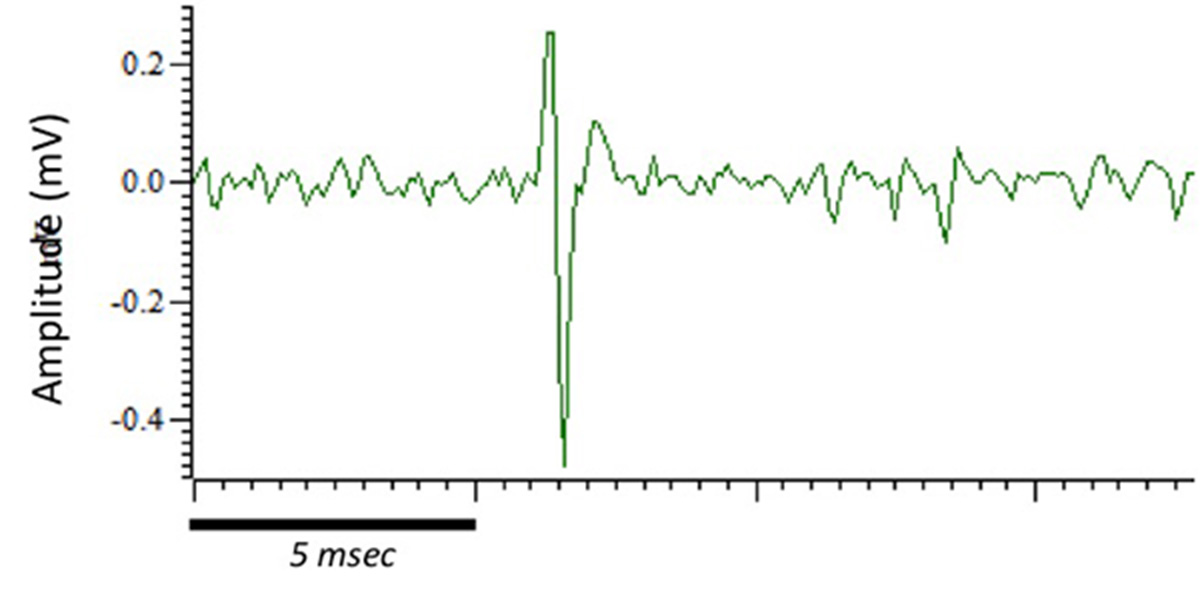 Subthalamic Nucleus (STN) Recording In Vivo | Melior